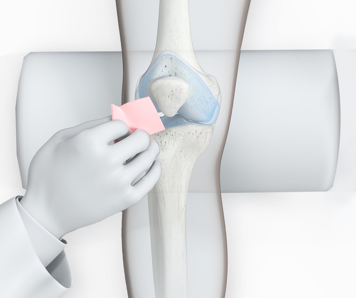 Arthrosamid Injections - The Knee Surgeon